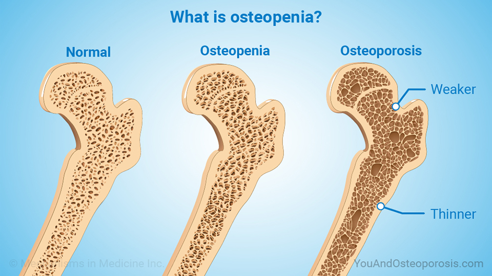 Osteomalacia Vs Osteoporosis
